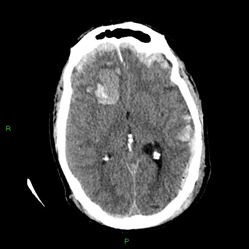 Traumatic Brain Injury – THE PTN