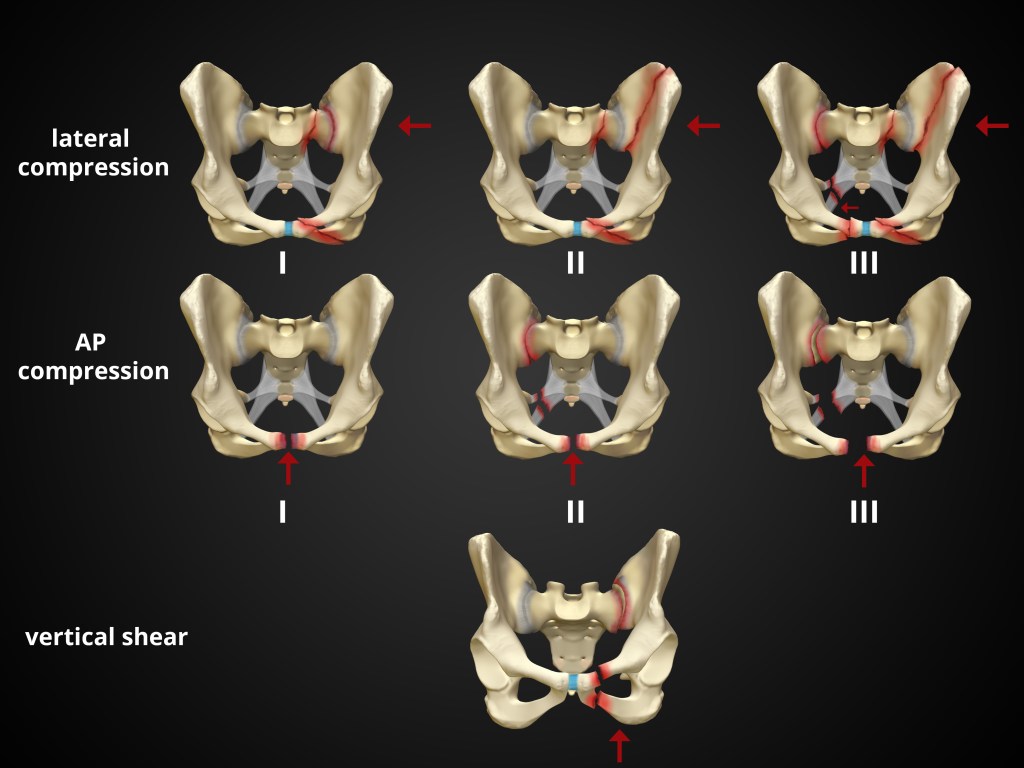 Pelvic Trauma – THE PTN