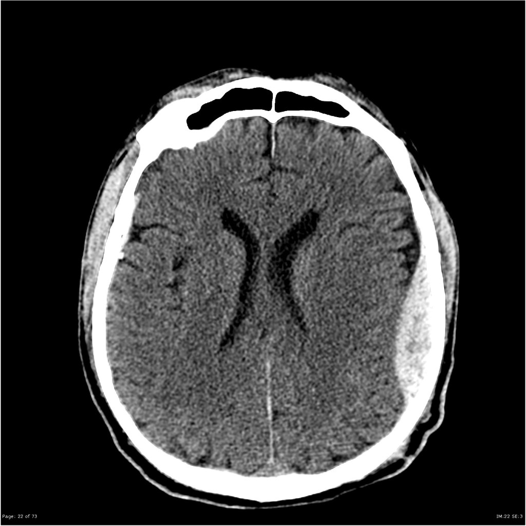 CT Head in Trauma – THE PTN